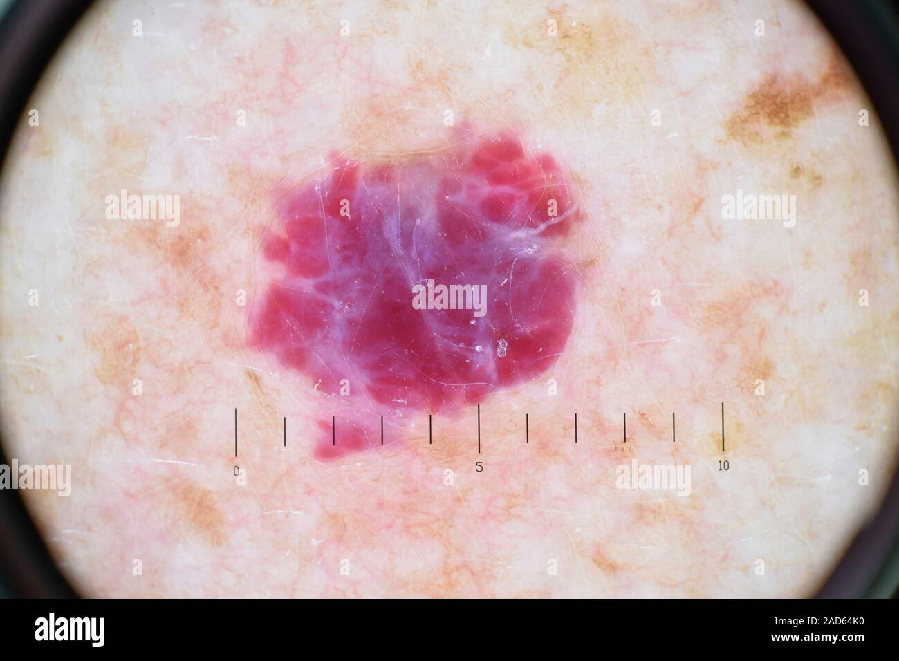 Capillary haemangioma. Dermatoscope image of a haemangioma on the ...