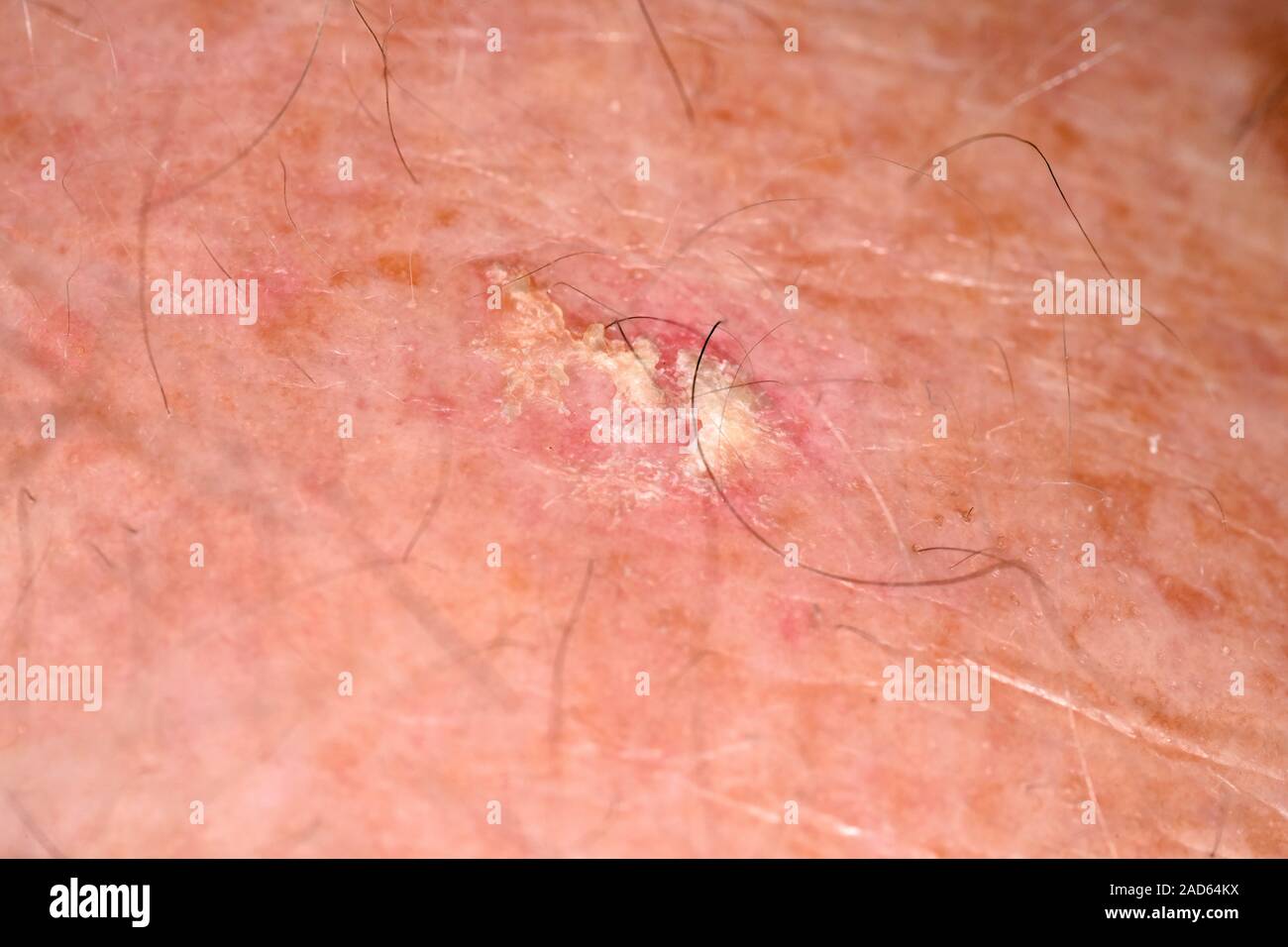Solar keratosis. Close-up of a lesion on the scalp of an 80-year-old ...