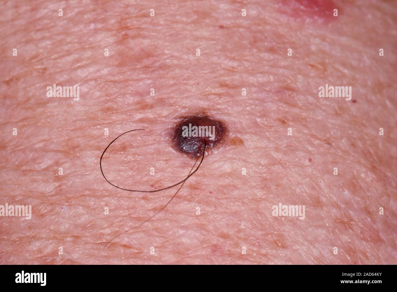Intradermal naevus. Close-up of a benign (non-cancerous) intradermal ...
