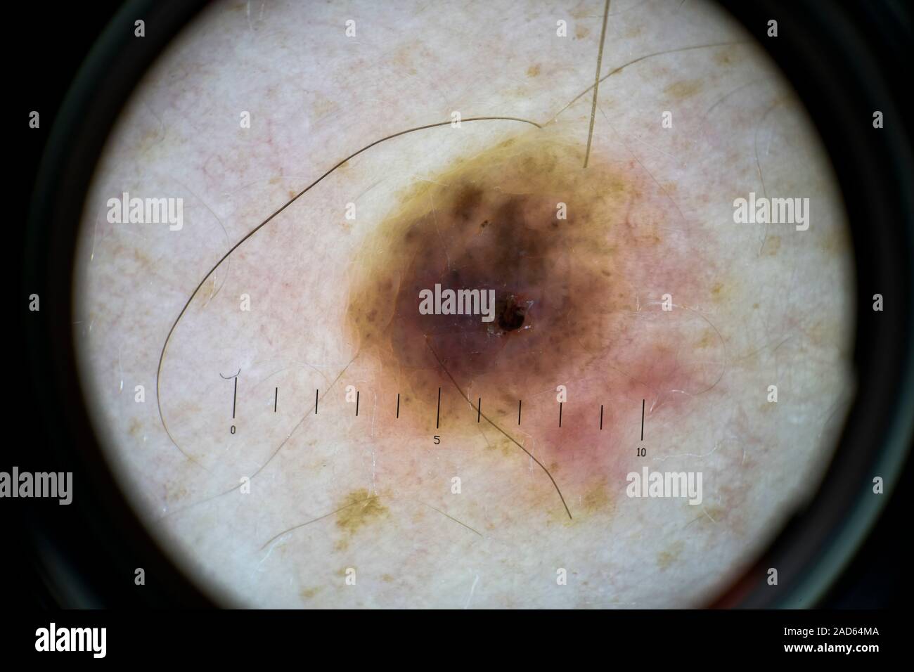 Junctional Naevus Mole On The Skin Stock Image C013 Junctional naevus ...