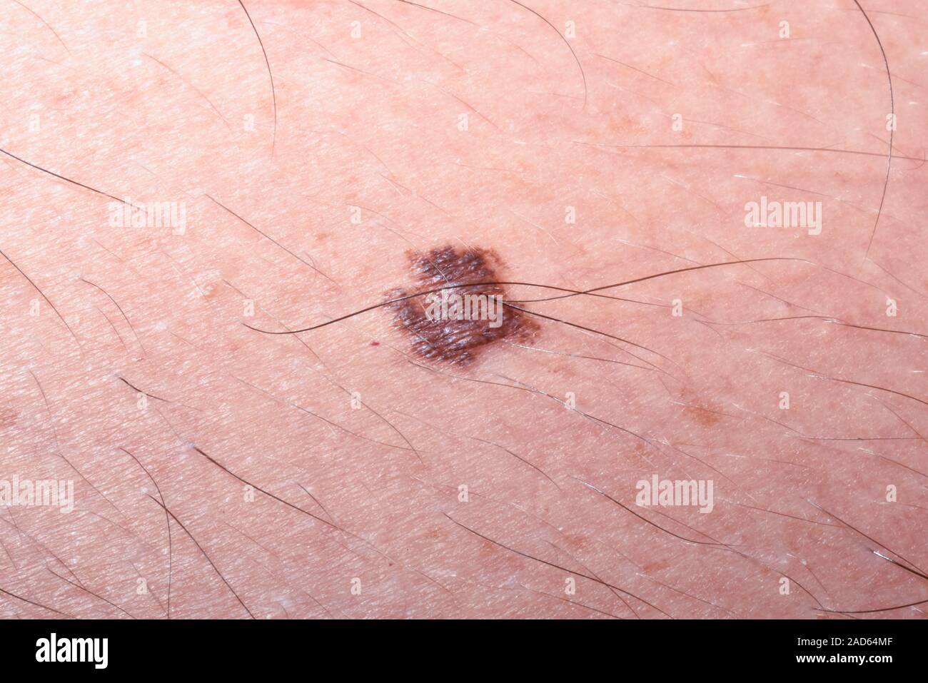 Globular naevus. Close-up of a globular naevus (mole) on the skin of a ...