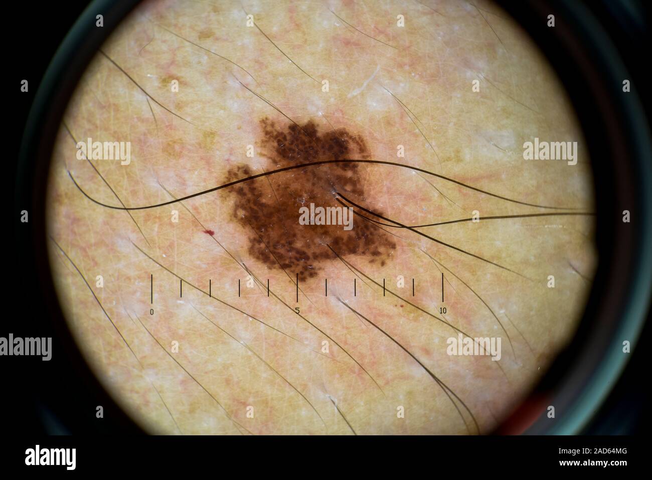 Junctional Naevus Mole On The Skin Stock Image C013 Junctional naevus ...