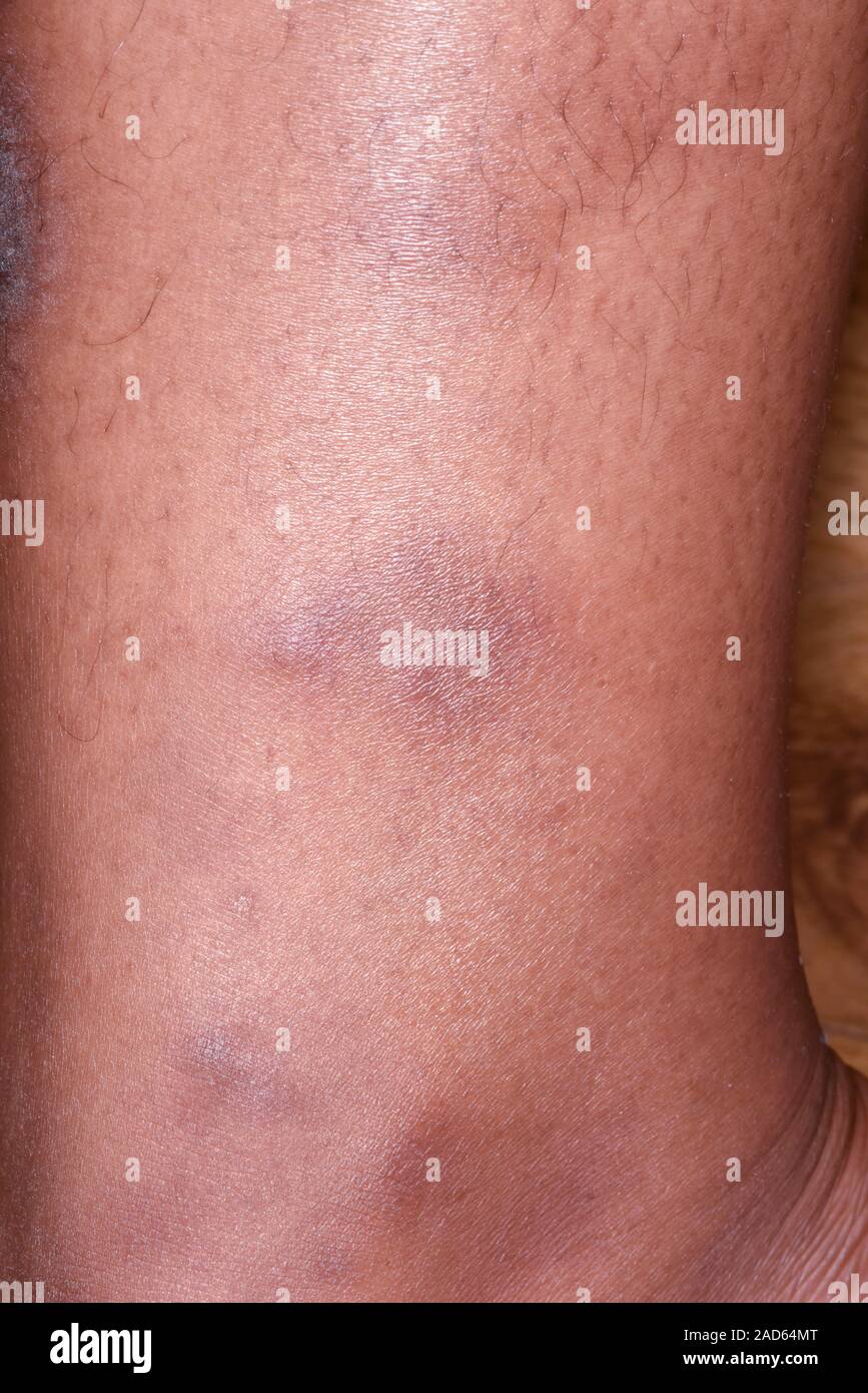 Lichen simplex. Close-up of lichen simplex chronicus rash on the skin ...