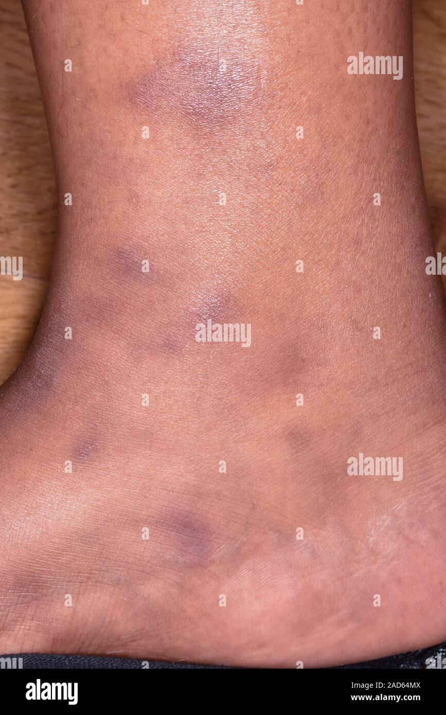 Lichen simplex. Close-up of lichen simplex chronicus rash on the skin ...