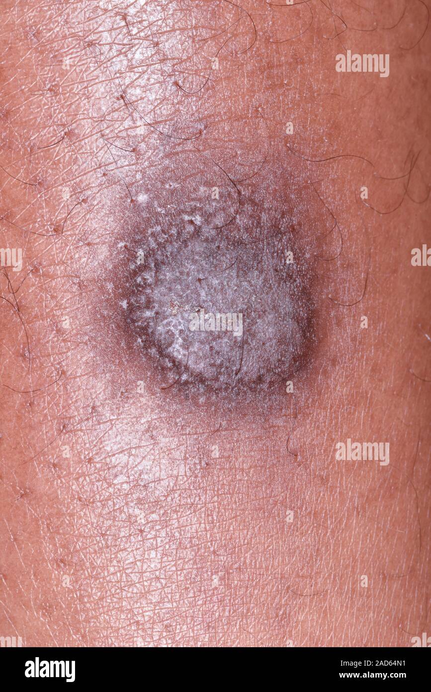 Lichen simplex. Close-up of lichen simplex chronicus rash on the skin ...