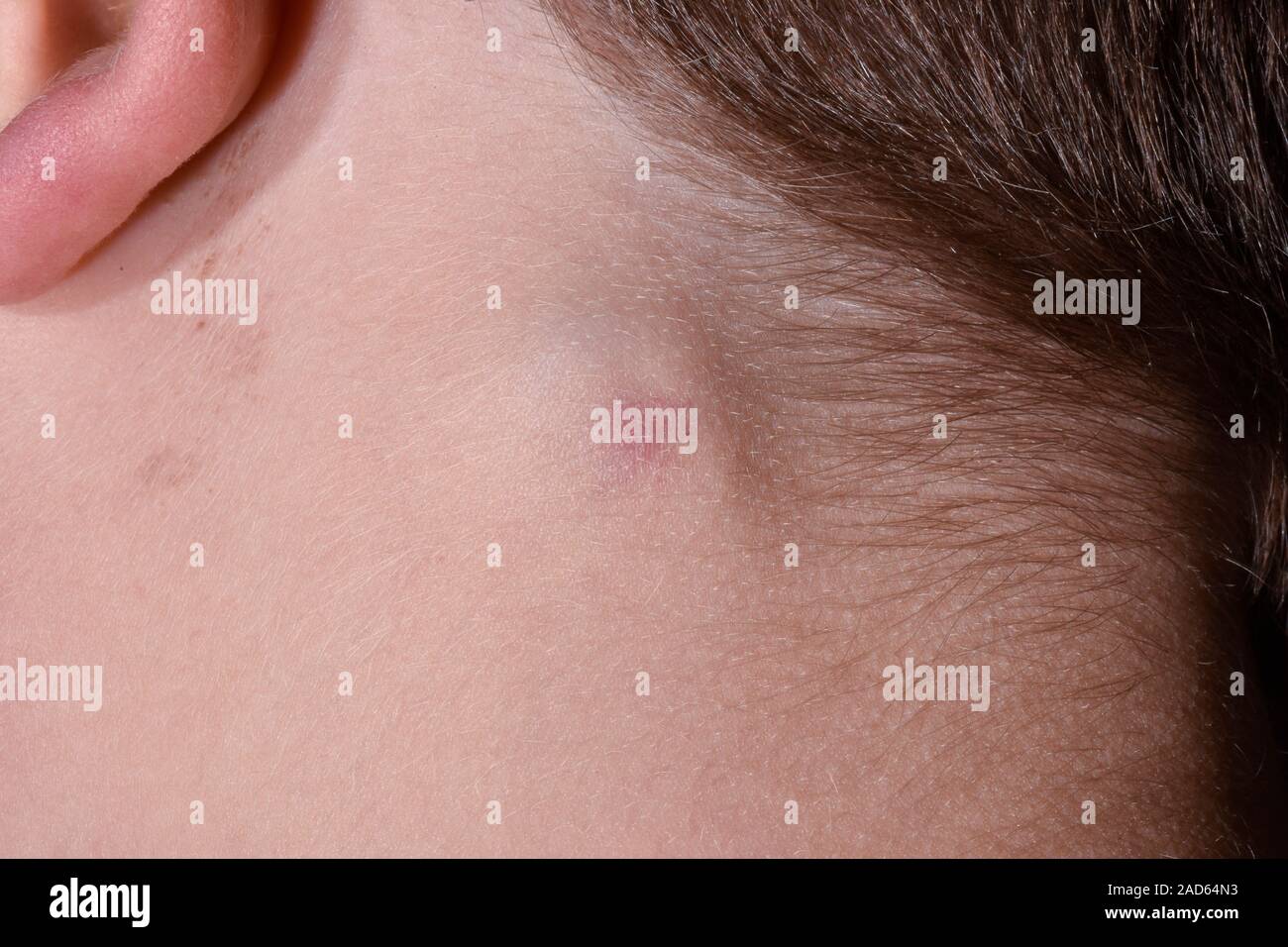 Pilomatrixoma. Close-up of swelling on the neck of a 5-year-old male ...