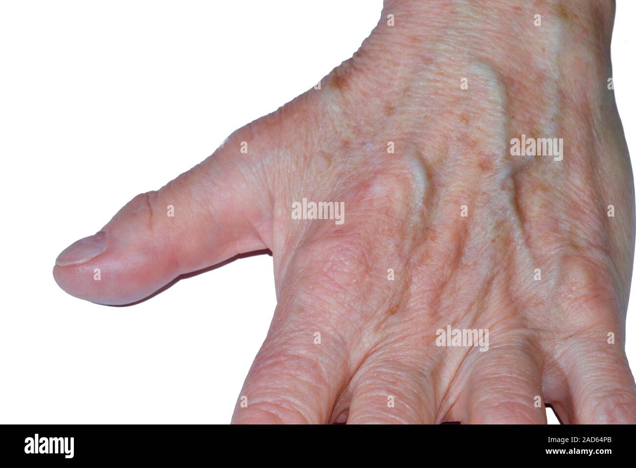 Muscle wasting in glioma cancer. Close-up the hand of a 76-year-old ...