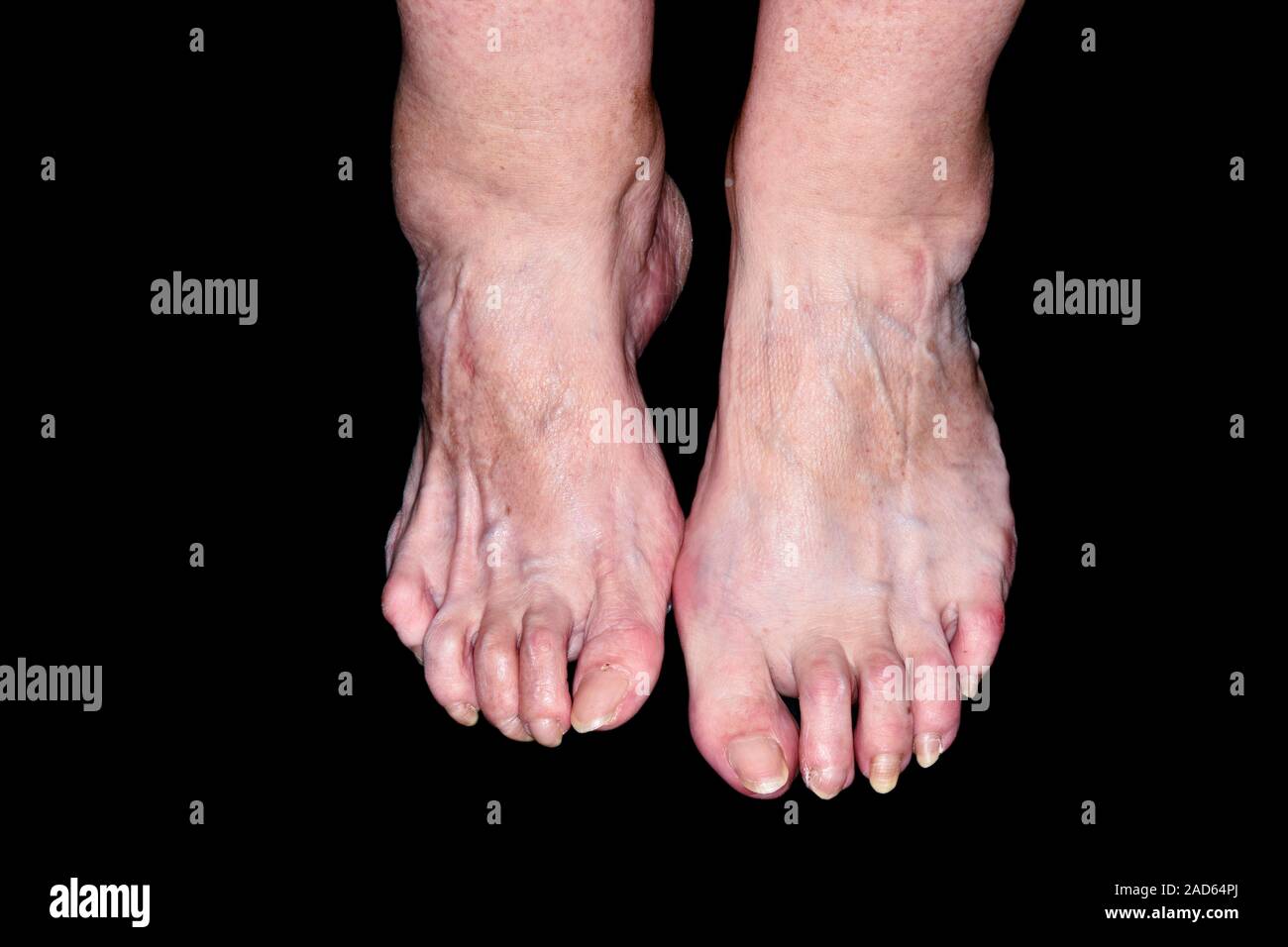 Growth defect in polio. Close-up of the feet of a 69-year-old female ...