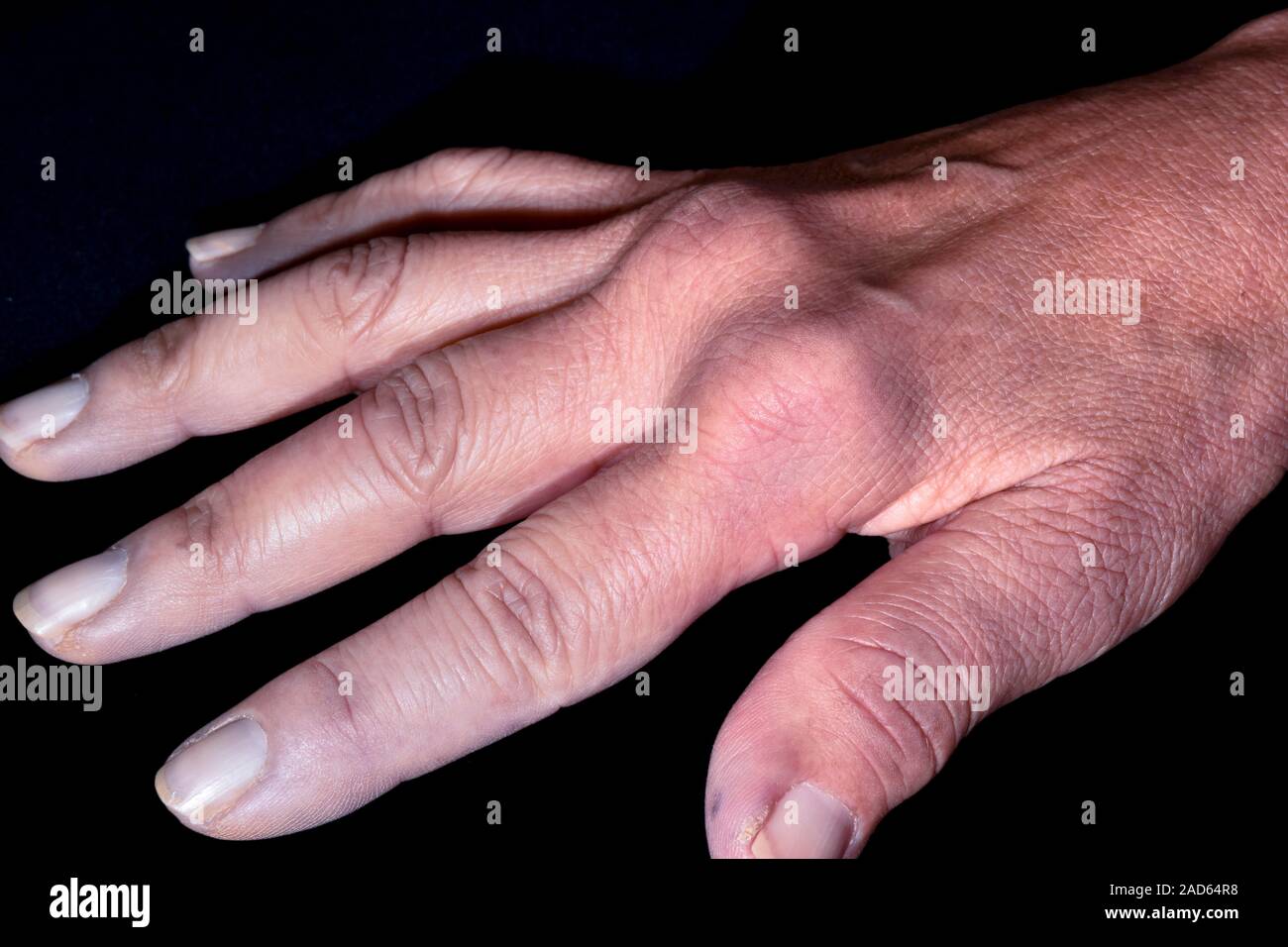 Hand in CREST syndrome. Close-up of the swollen hand of a 69-year-old ...