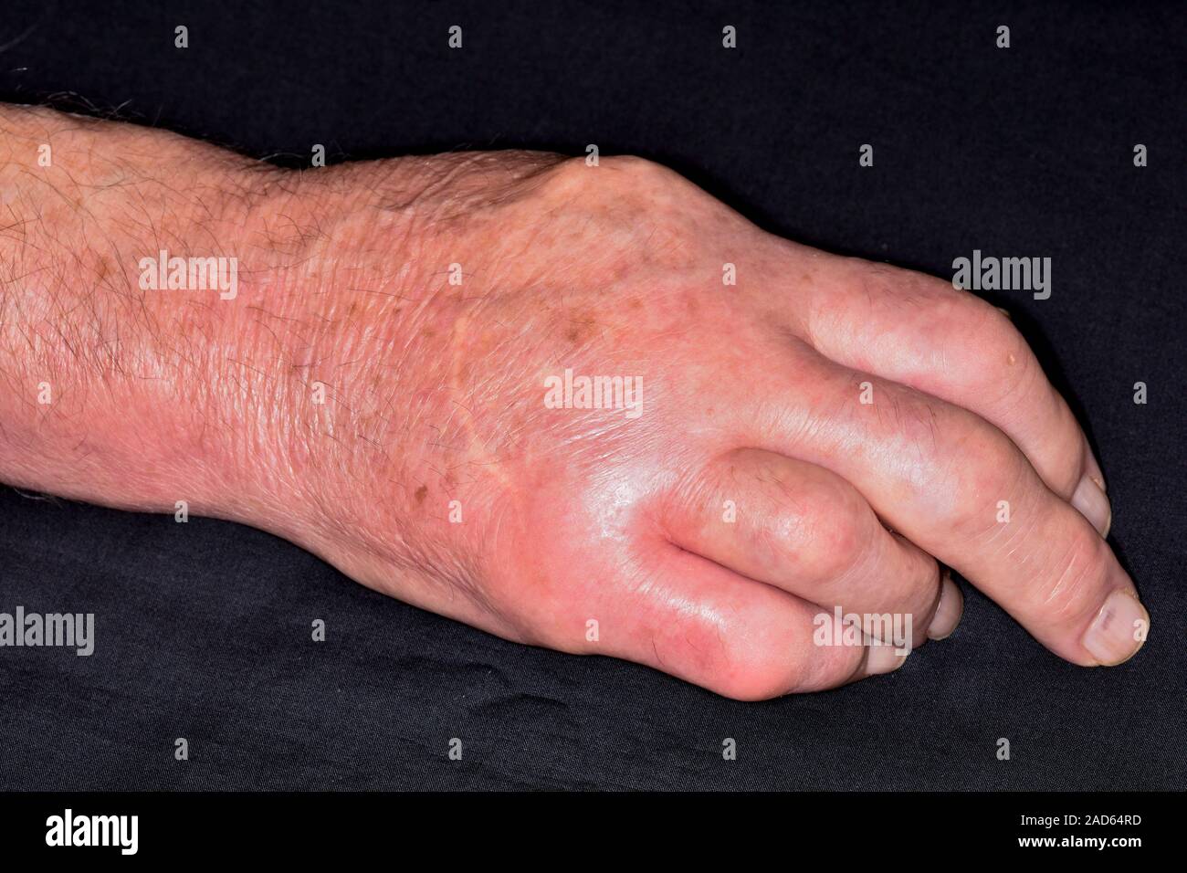 Swollen hand in gout. Close-up of the reddened swollen hand of a 90 ...