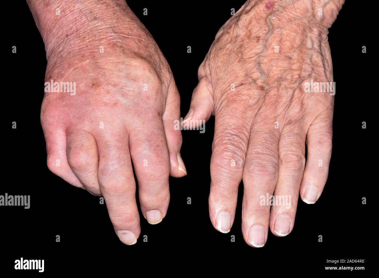 Swollen hand in gout. Close-up of the hands of a 90-year-old male ...