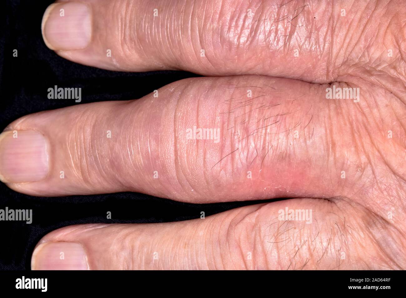 Fingers in osteoarthritis. Close-up of the swollen fingers of a 90-year ...