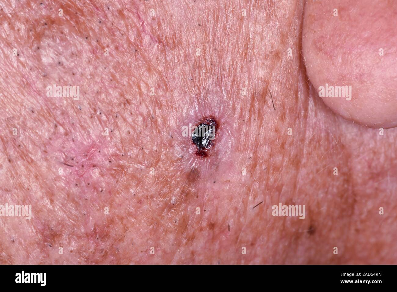 Basal cell carcinoma skin cancer. Close-up of a basal cell carcinoma ...
