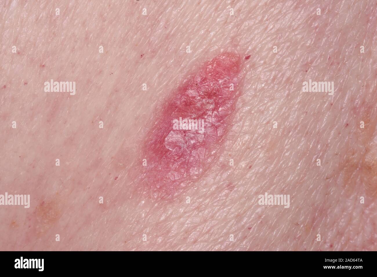 Basal cell carcinoma skin cancer. Close-up of a superficial spreading ...