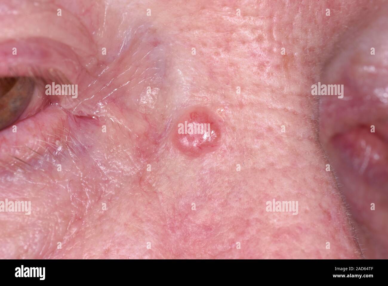 Basal Cell Carcinoma Skin Cancer Close Up Of A Nodular Basal Cell Carcinoma Bcc On The Nose