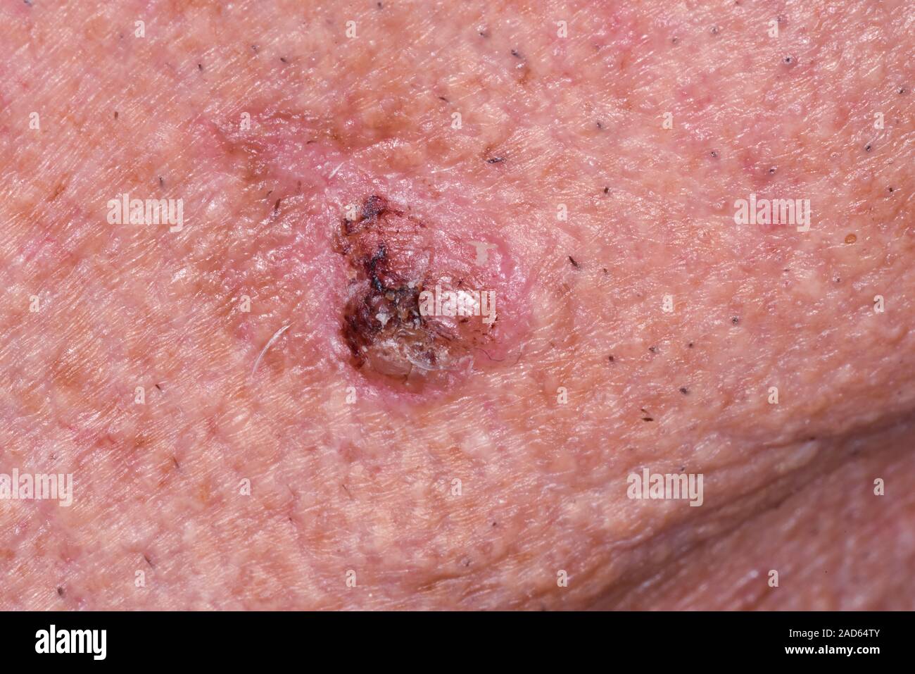 Squamous cell carcinoma skin cancer. Close-up of a well-differentiated ...