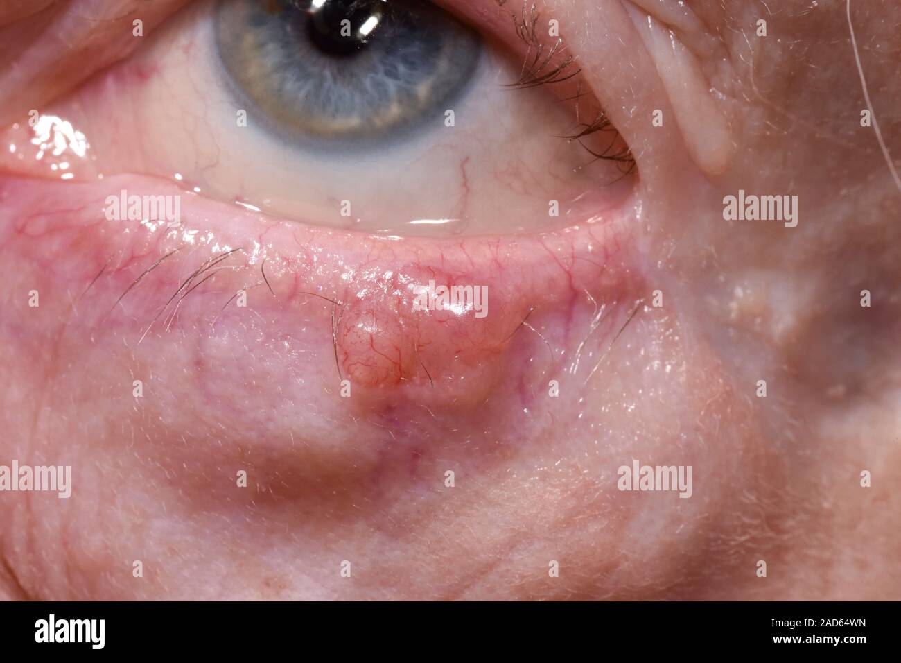 Basal cell carcinoma of the eye. Close-up of a basal cell carcinoma ...