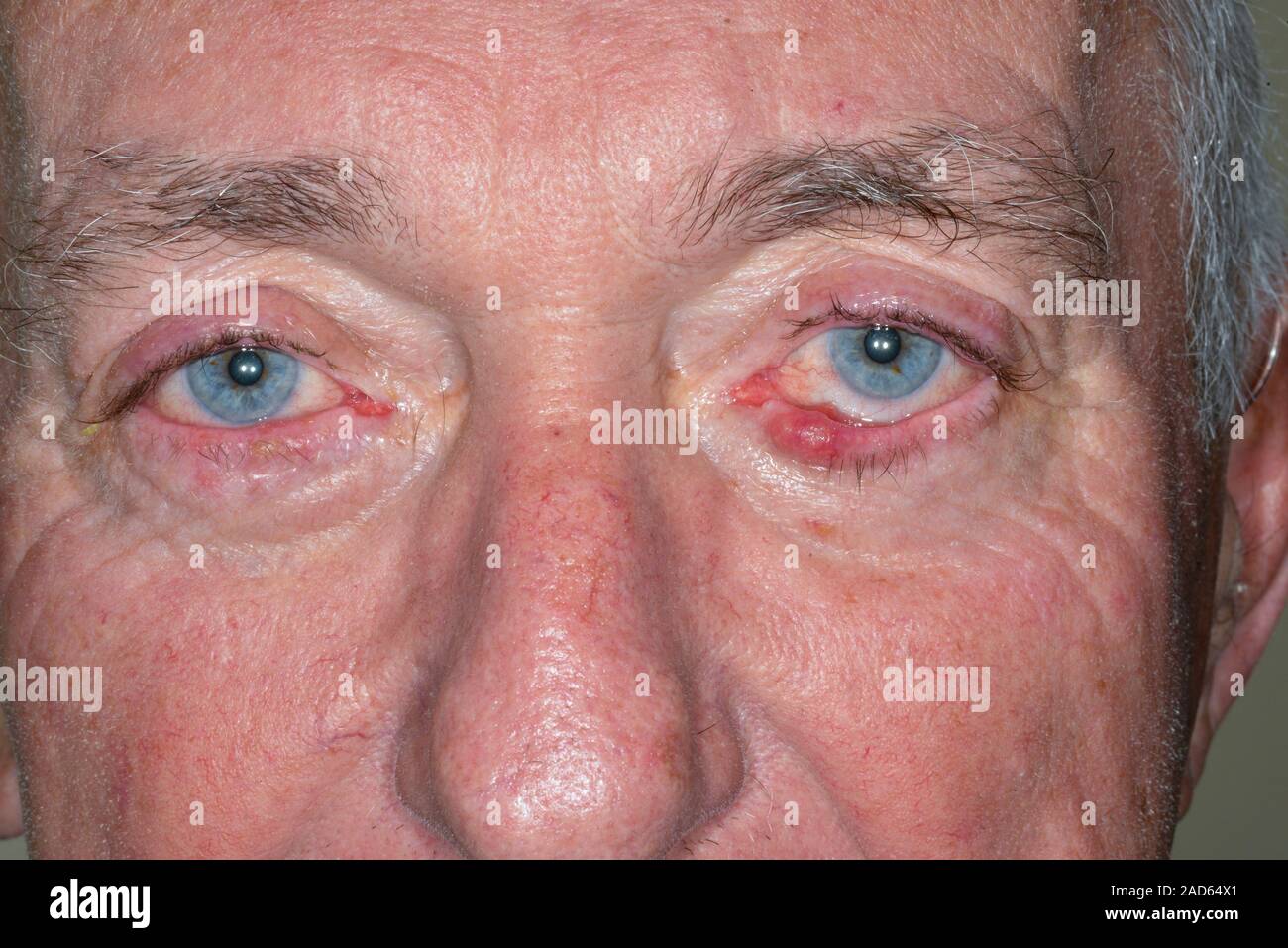Meibomian Cyst Close Up Of A Meibomian Cyst Chalazion On The Lower
