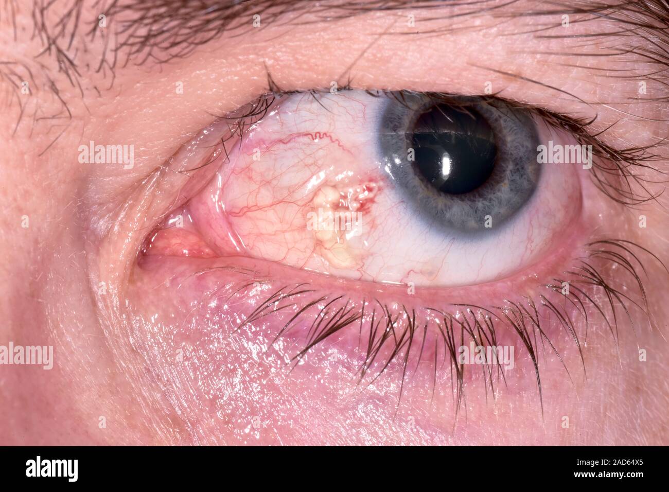 Moll's cyst in the eyelid. Close-up of a Moll's cyst on the lower ...