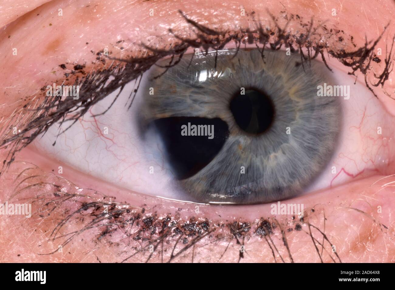 Eye damage from accident. Close-up of the eye of a 34-year-old female ...