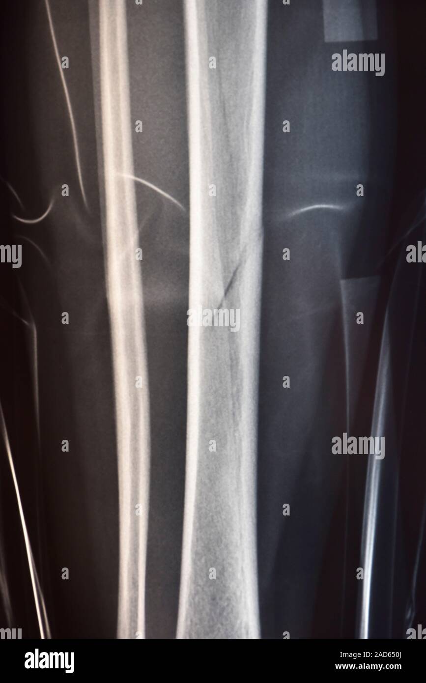 Fractured shin bone. X-ray of the leg of a 6-year-old female patient ...