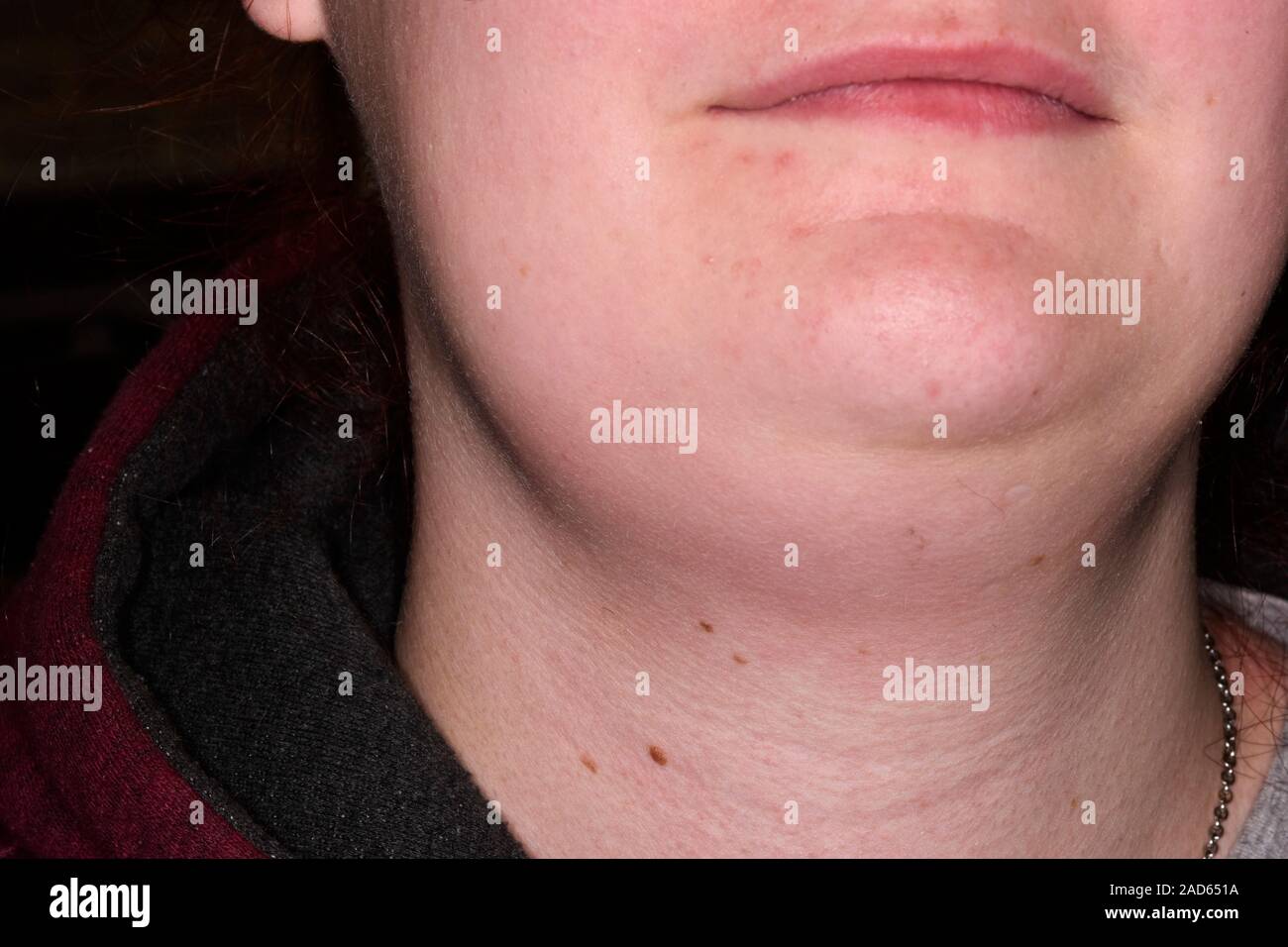 Swollen lymph glands in neck. Close-up of the swollen neck of an 18 ...