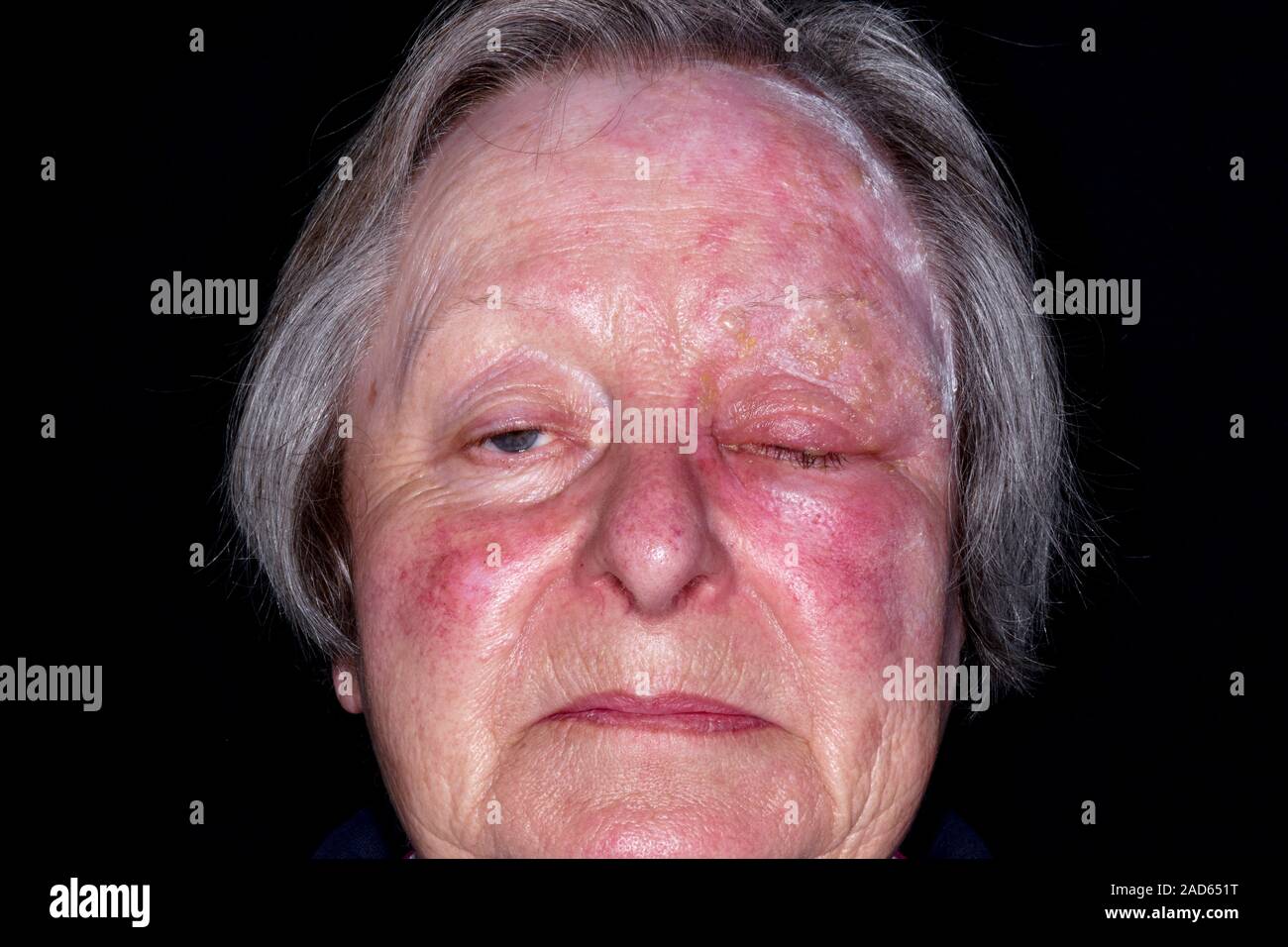 Shingles Rash Blisters And Rash Around The Eye Of A 69 Year Old Female Patient With Shingles