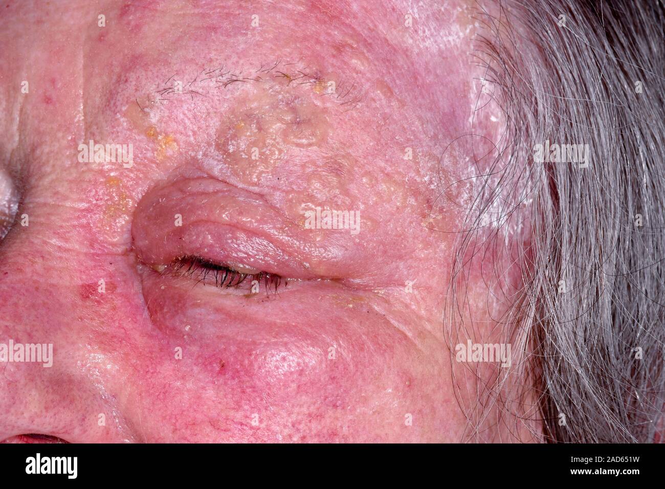 Shingles Rash Close Up Of Blisters And Rash Around The Eye Of A 69 Year Old Female Patient With