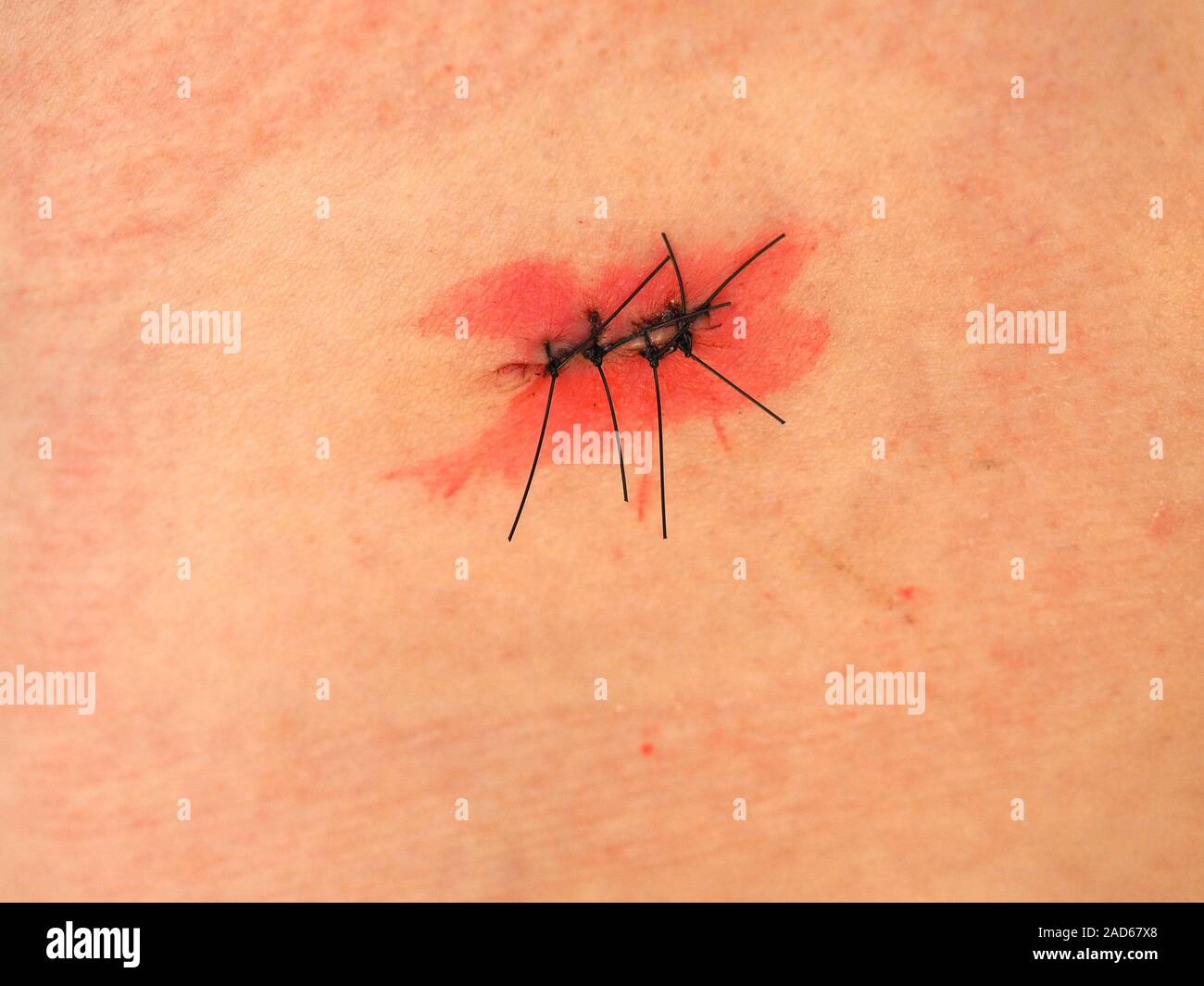 surgical wound with stitches and iodine tincture Stock Photo - Alamy