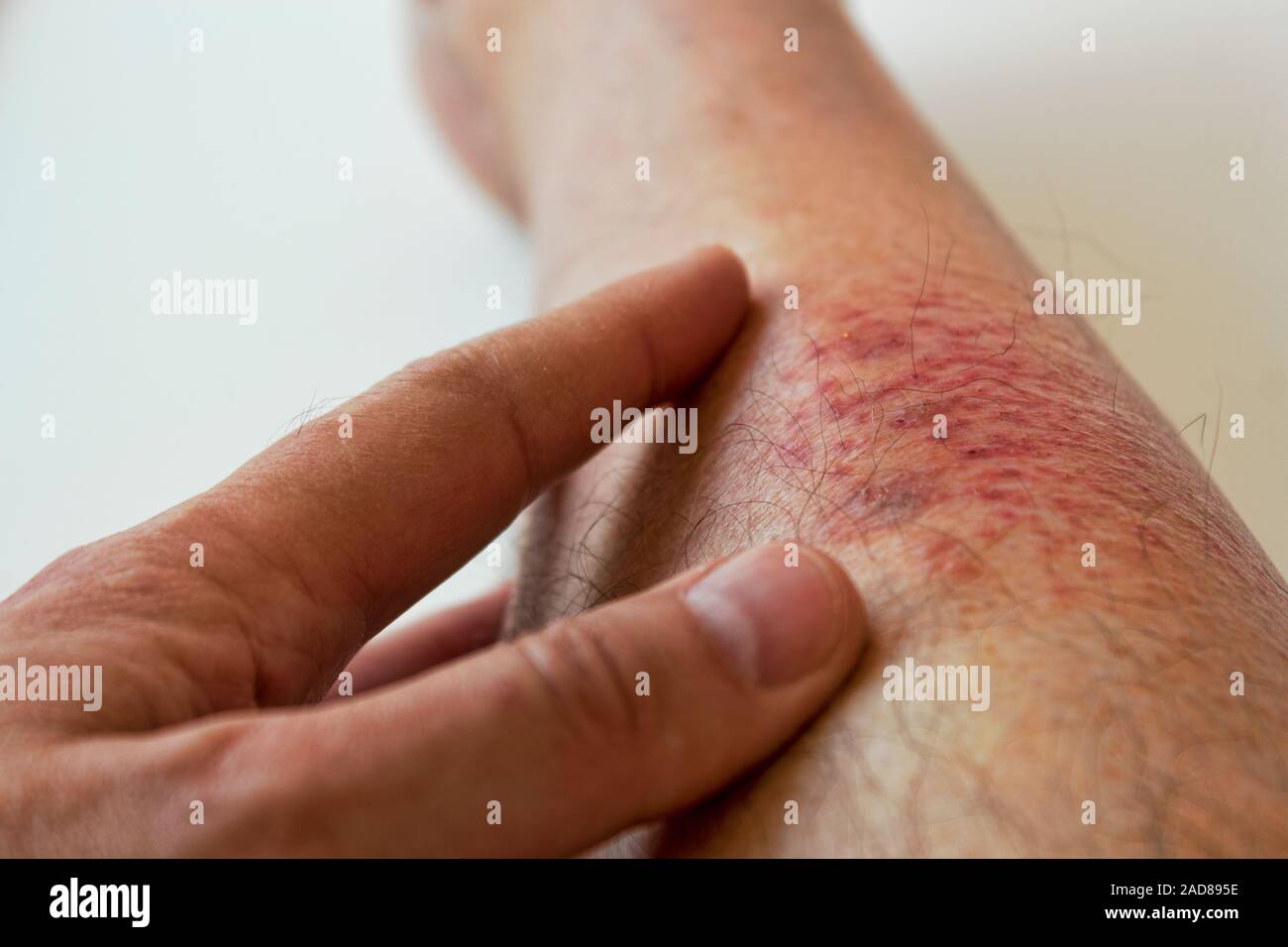 Hautekzem hi-res stock photography and images - Alamy