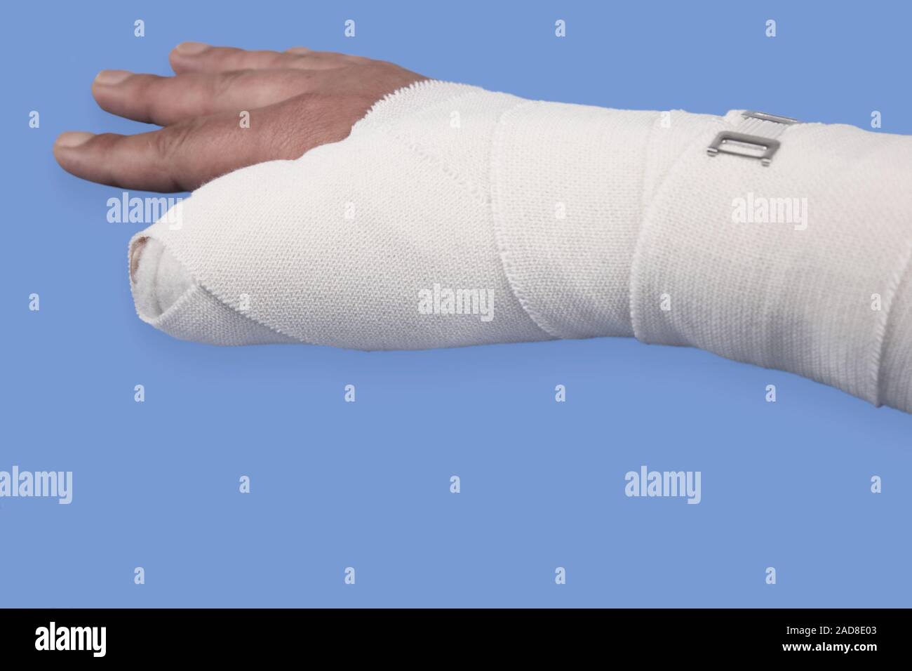 Arm of plaster hi-res stock photography and images - Alamy
