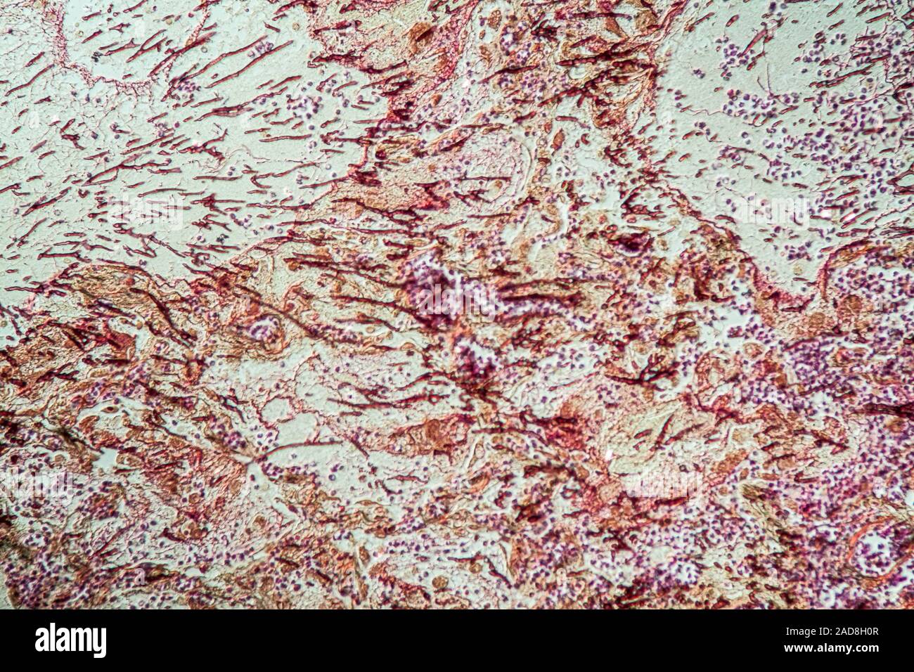 Lungs of an AIDS patient Infection with Candida and Aspergillus 100x ...
