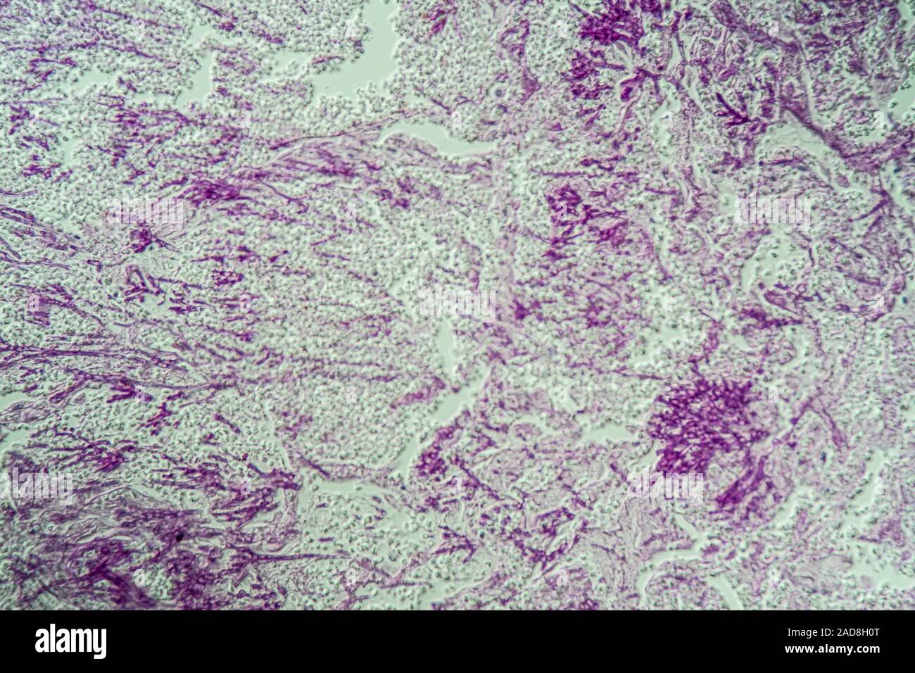 Lungs of an AIDS patient Infection with Candida and Aspergillus 100x ...