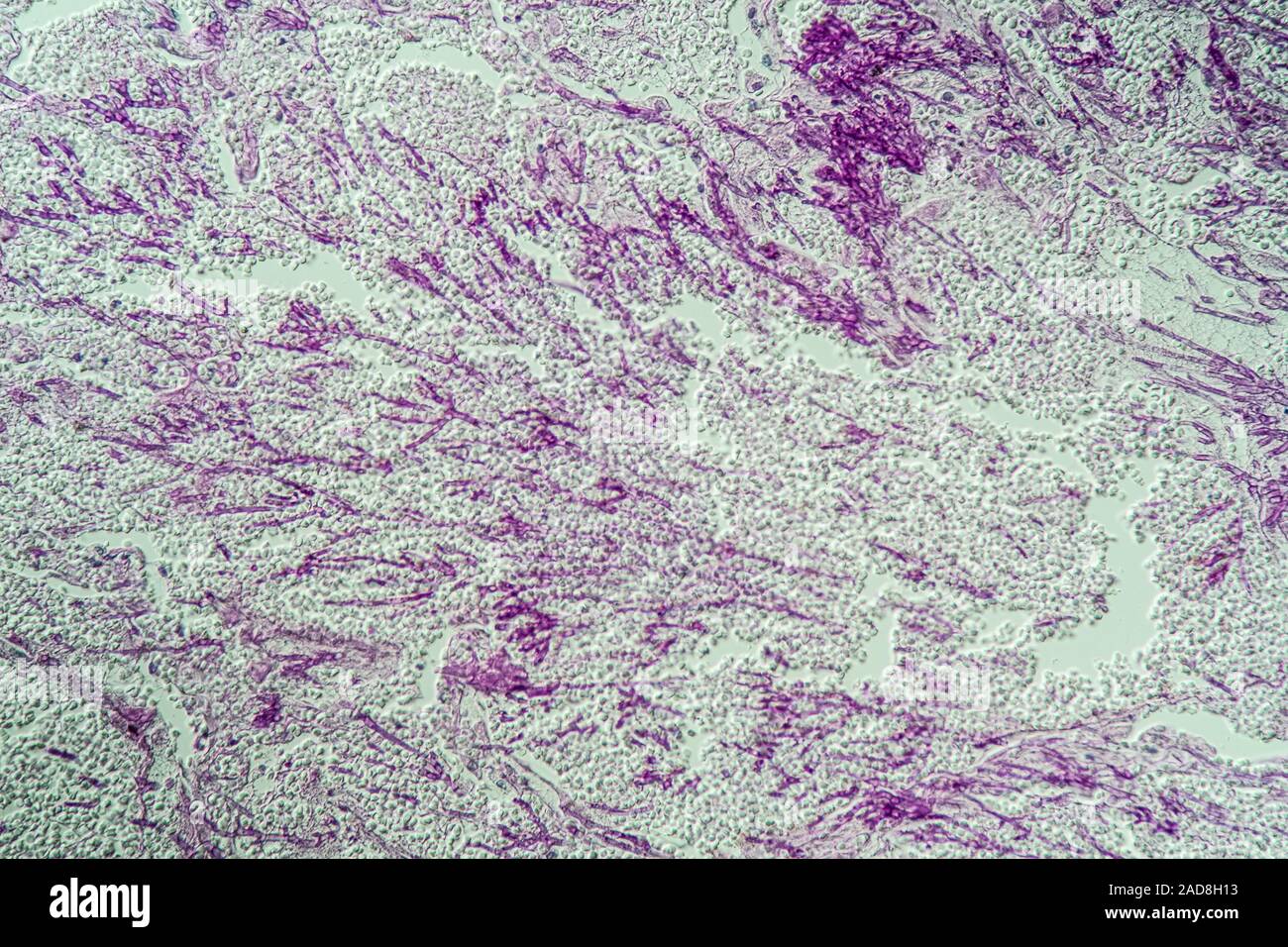 Lungs of an AIDS patient Infection with Candida and Aspergillus 100x ...