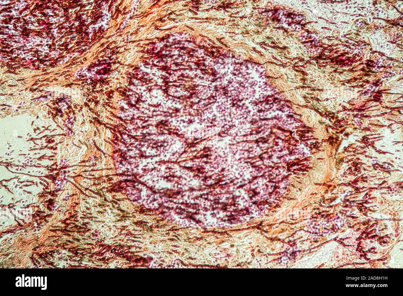 Lungs of an AIDS patient Infection with Candida and Aspergillus 100x ...