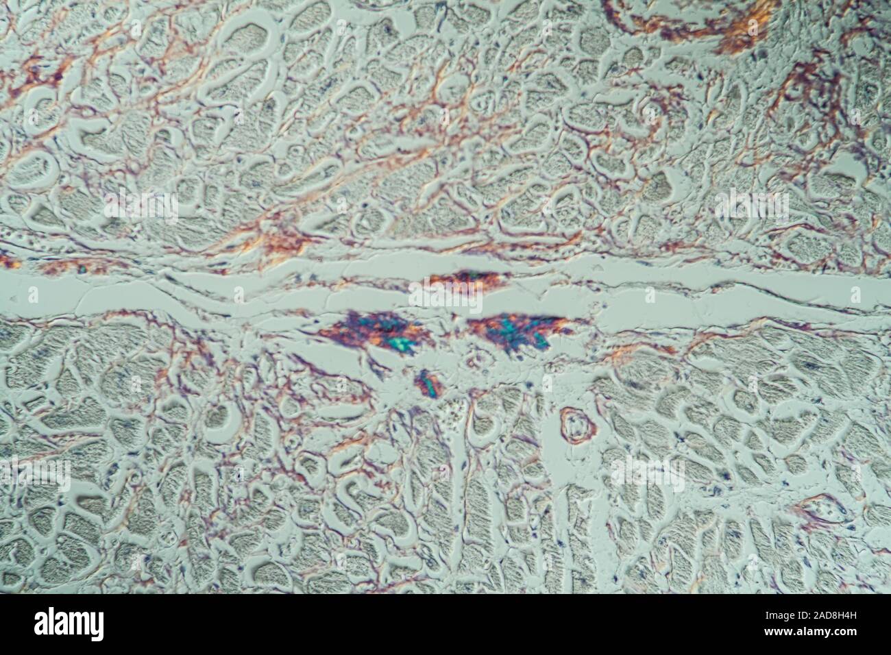 Amyloid deposits in the heart diseased tissue under the microscope 200x ...