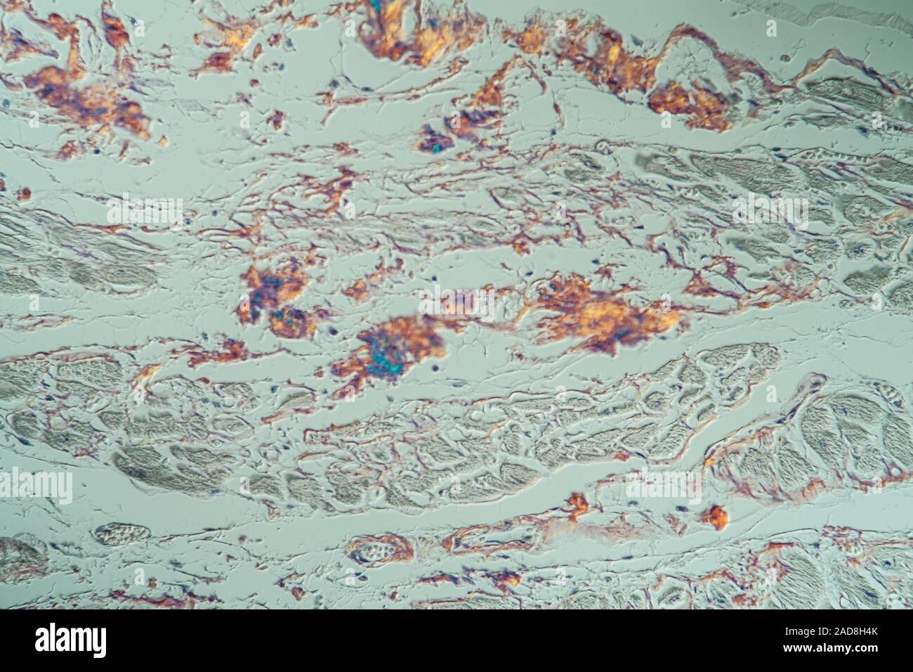 Amyloid deposits in the heart diseased tissue under the microscope 200x ...