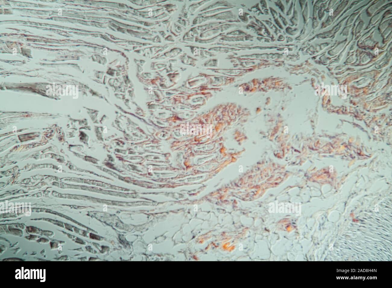 Amyloid deposits in the tongue diseased tissue under the microscope ...