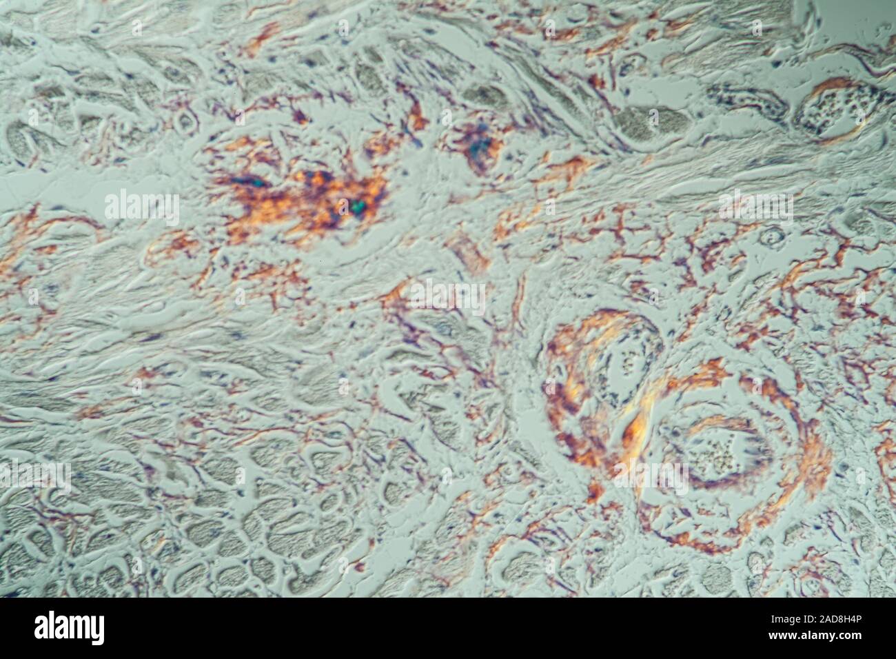 Amyloid deposits in the heart diseased tissue under the microscope 200x ...