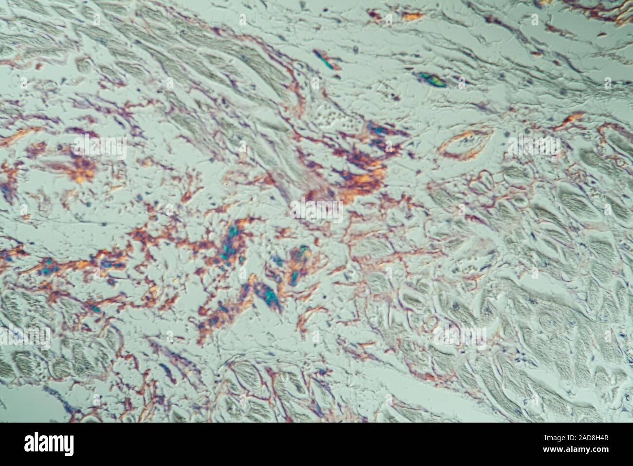 Amyloid deposits in the heart diseased tissue under the microscope 200x ...