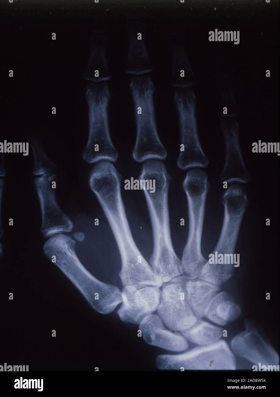 X-ray picture of the injured hand Stock Photo - Alamy
