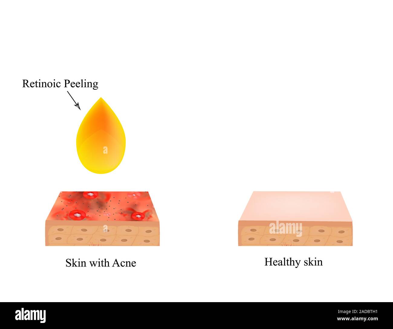 Retinoic peeling for acne. Inflamed skin acne. Acne purulent. The ...