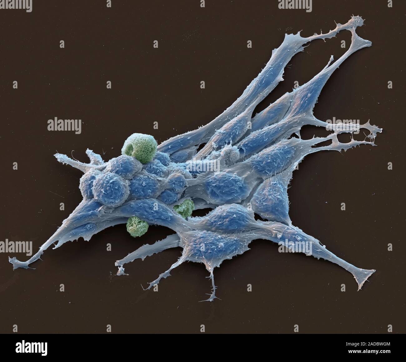 Prostate cancer cells, coloured scanning electron micrograph (SEM). The ...