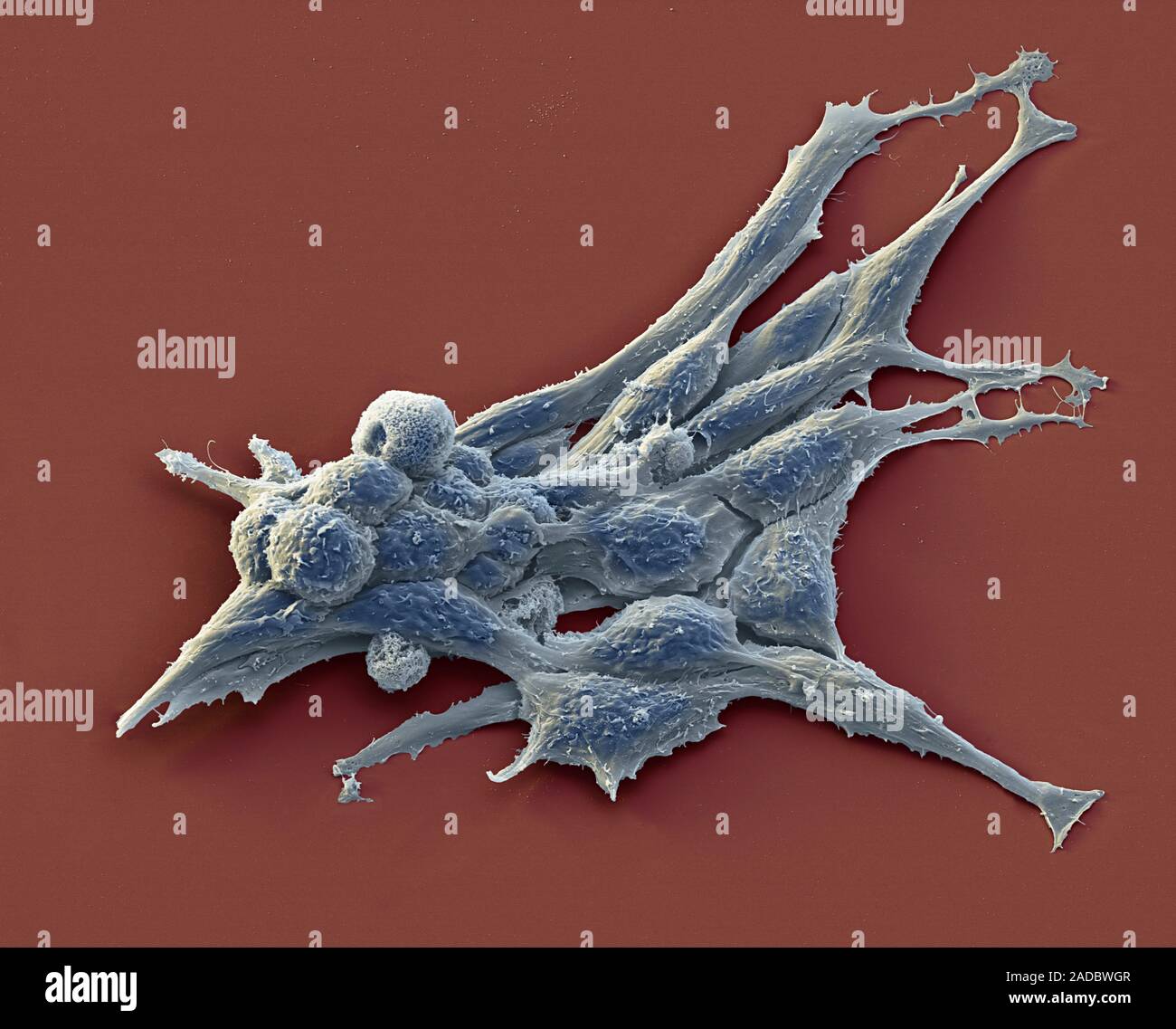Prostate cancer cells, coloured scanning electron micrograph (SEM). The ... Prostate cancer cells, coloured scanning electron micrograph (SEM). The ...