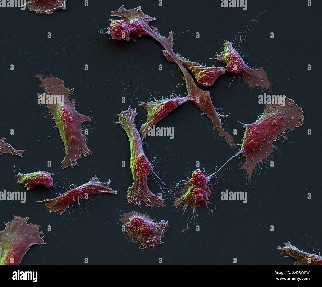 Rhabdomyosarcoma cancer cells, coloured scanning electron micrograph ...