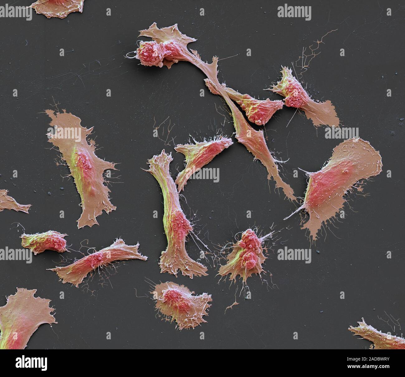 Rhabdomyosarcoma cancer cells, coloured scanning electron micrograph ...