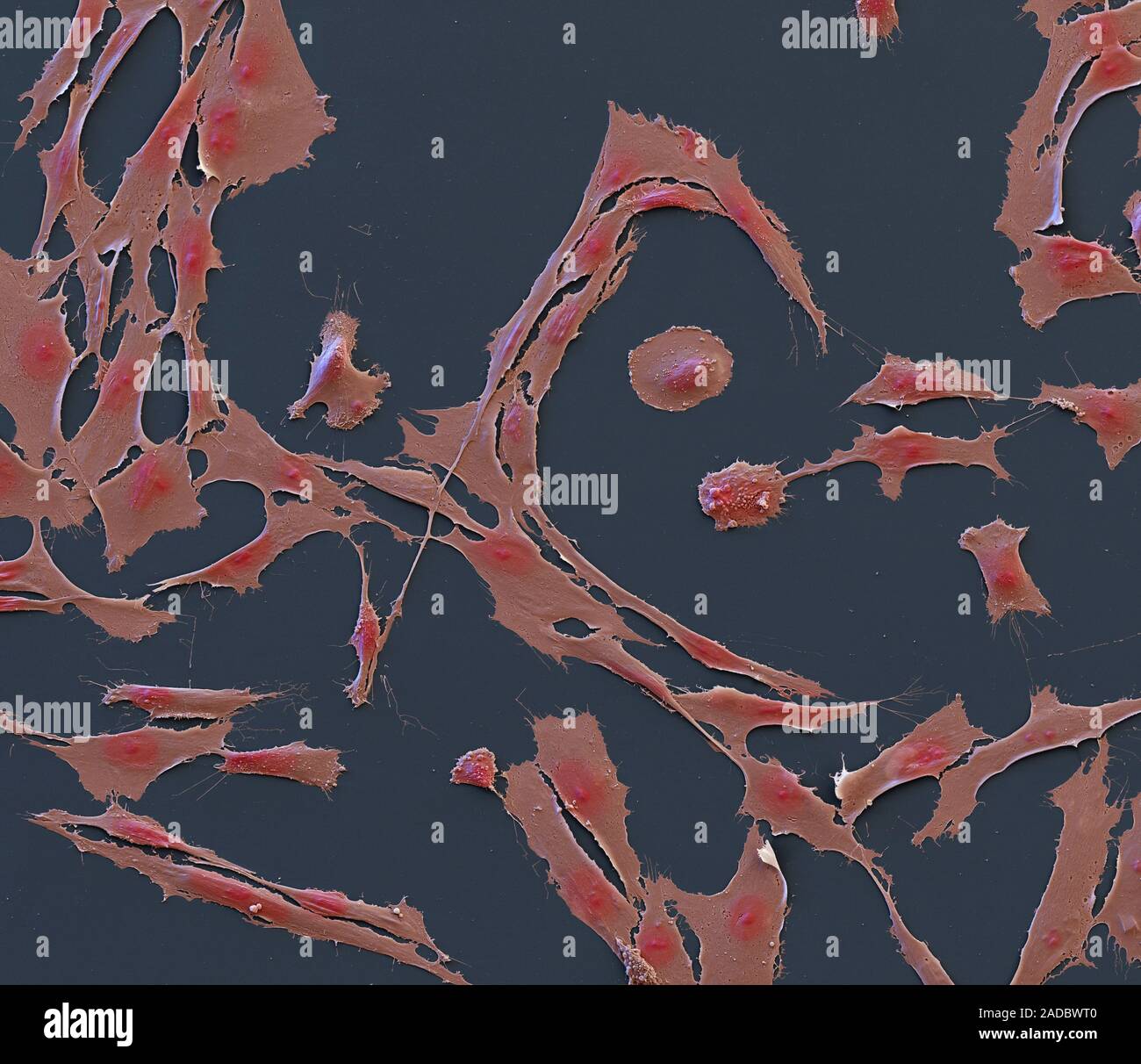 Rhabdomyosarcoma cancer cells, coloured scanning electron micrograph ...