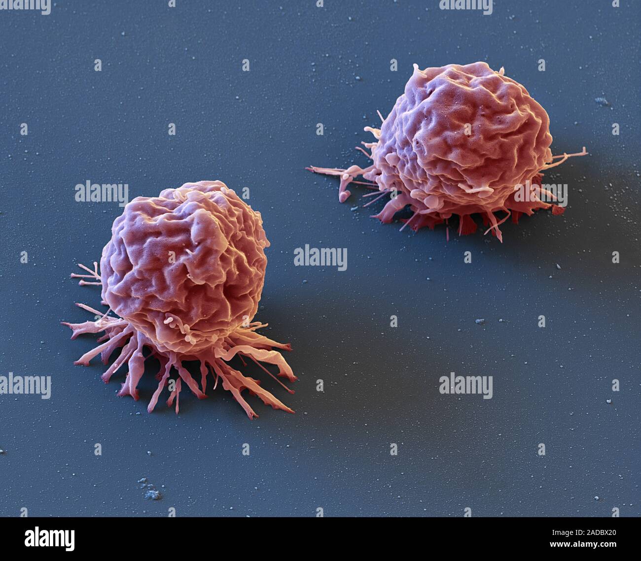 Acute lymphoblastic leukemia (ALL) cells, coloured scanning electron ...
