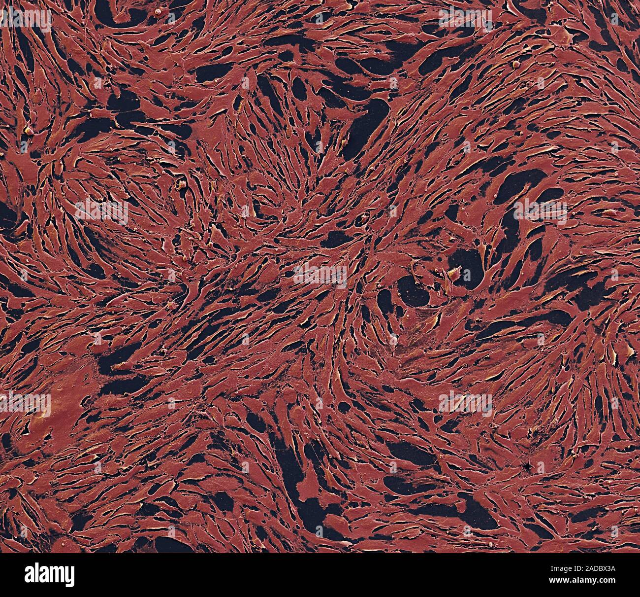 Rhabdomyosarcoma cancer cells, coloured scanning electron micrograph ...