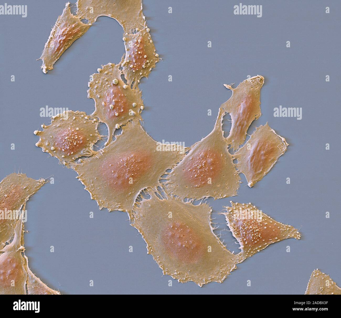 Coloured scanning electron micrograph of osteosarcoma cancer cells ...